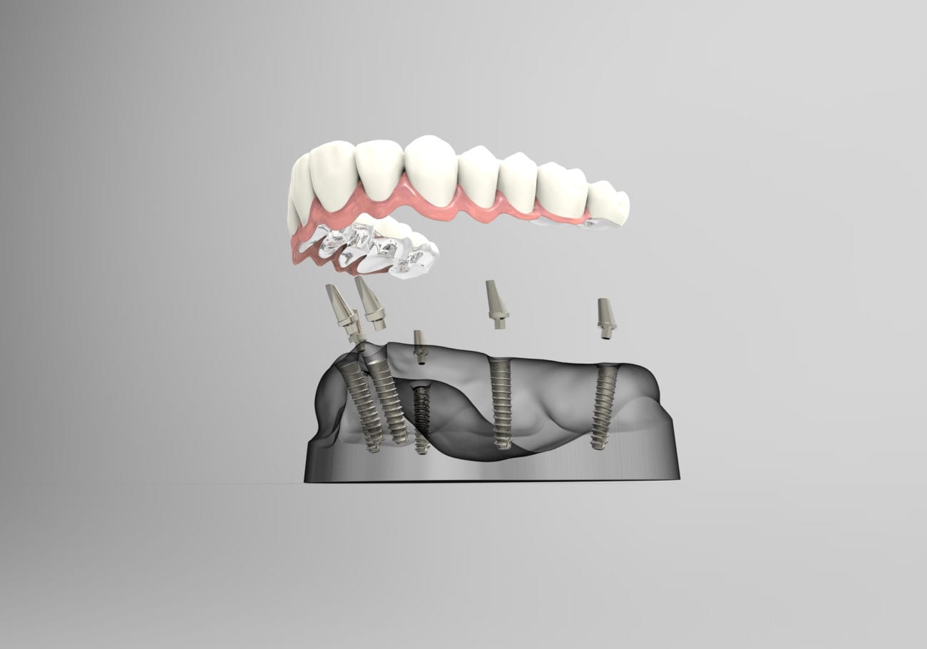Multiple Dental Implants Silver Spring MD | Teeth Implants